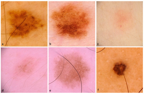 Exploring Small-Diameter Melanomas: A Retrospective Study on Clinical ...