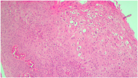 Surgical Management of Perianal Giant Condyloma Acuminatum of Buschke ...