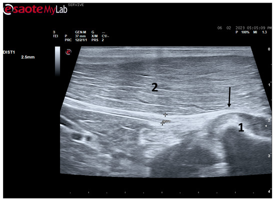 Ultrasound Landmarks in the Approach to the Common Peroneal Nerve in a ...