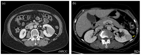 Exploratory Analysis of the Role of Radiomic Features in the ...