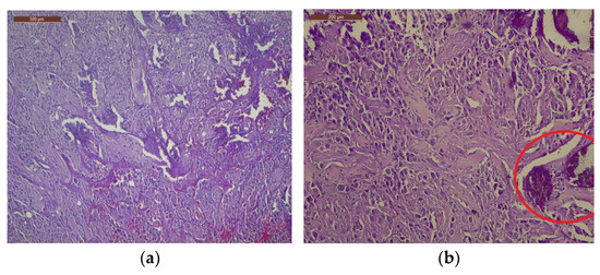 Chronic Diarrhea Caused by Vasoactive Intestinal Peptide-Secreting Tumor