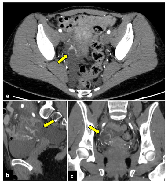 Gynaecological Causes of Acute Pelvic Pain: Common and Not-So-Common ...