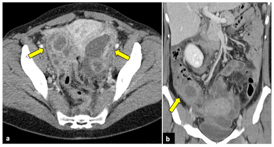 Gynaecological Causes of Acute Pelvic Pain: Common and Not-So-Common ...