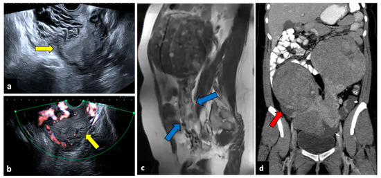 Gynaecological Causes of Acute Pelvic Pain: Common and Not-So-Common ...