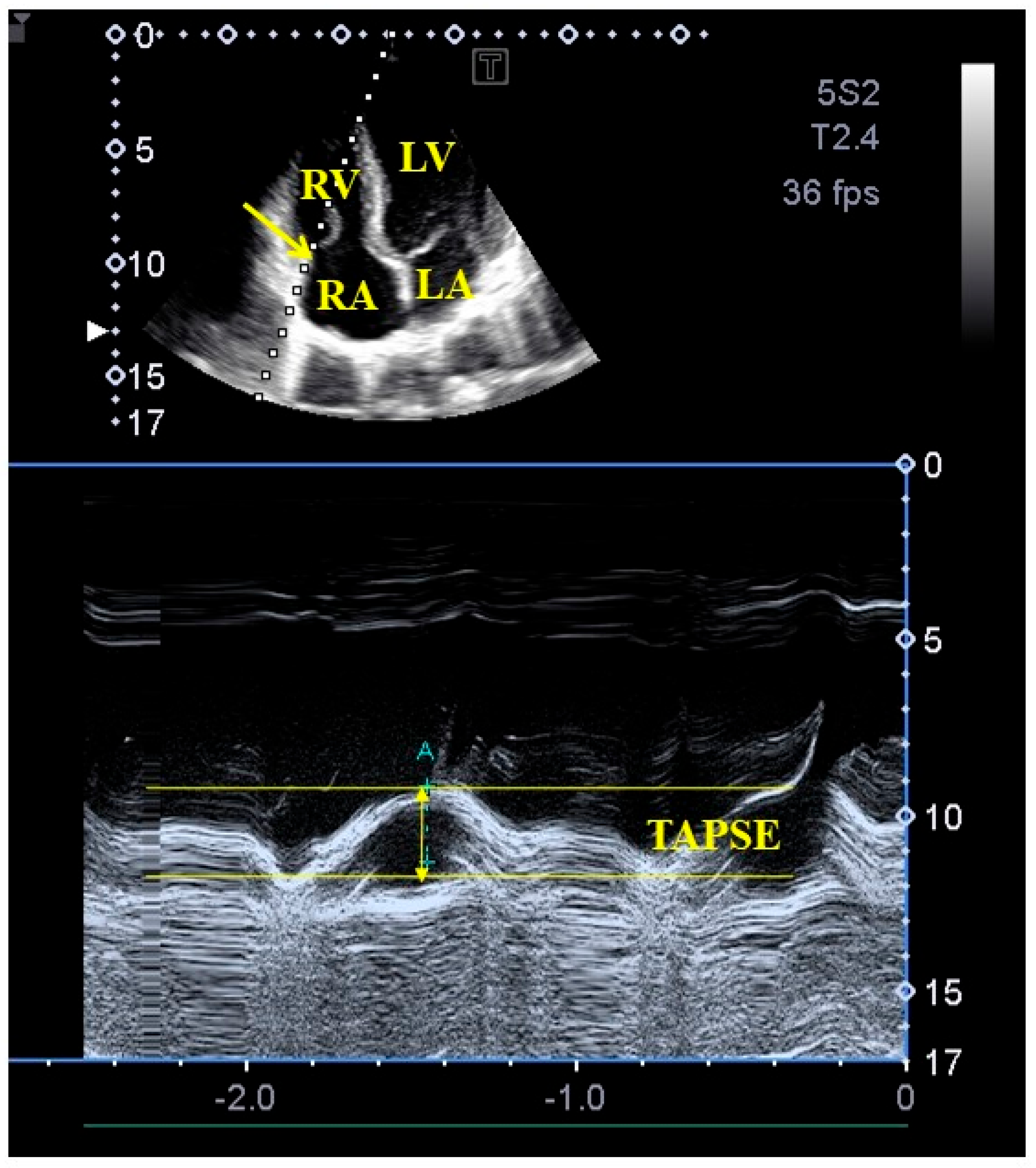 The Relationship between Tricuspid Annular Longitudinal and Sphincter ...