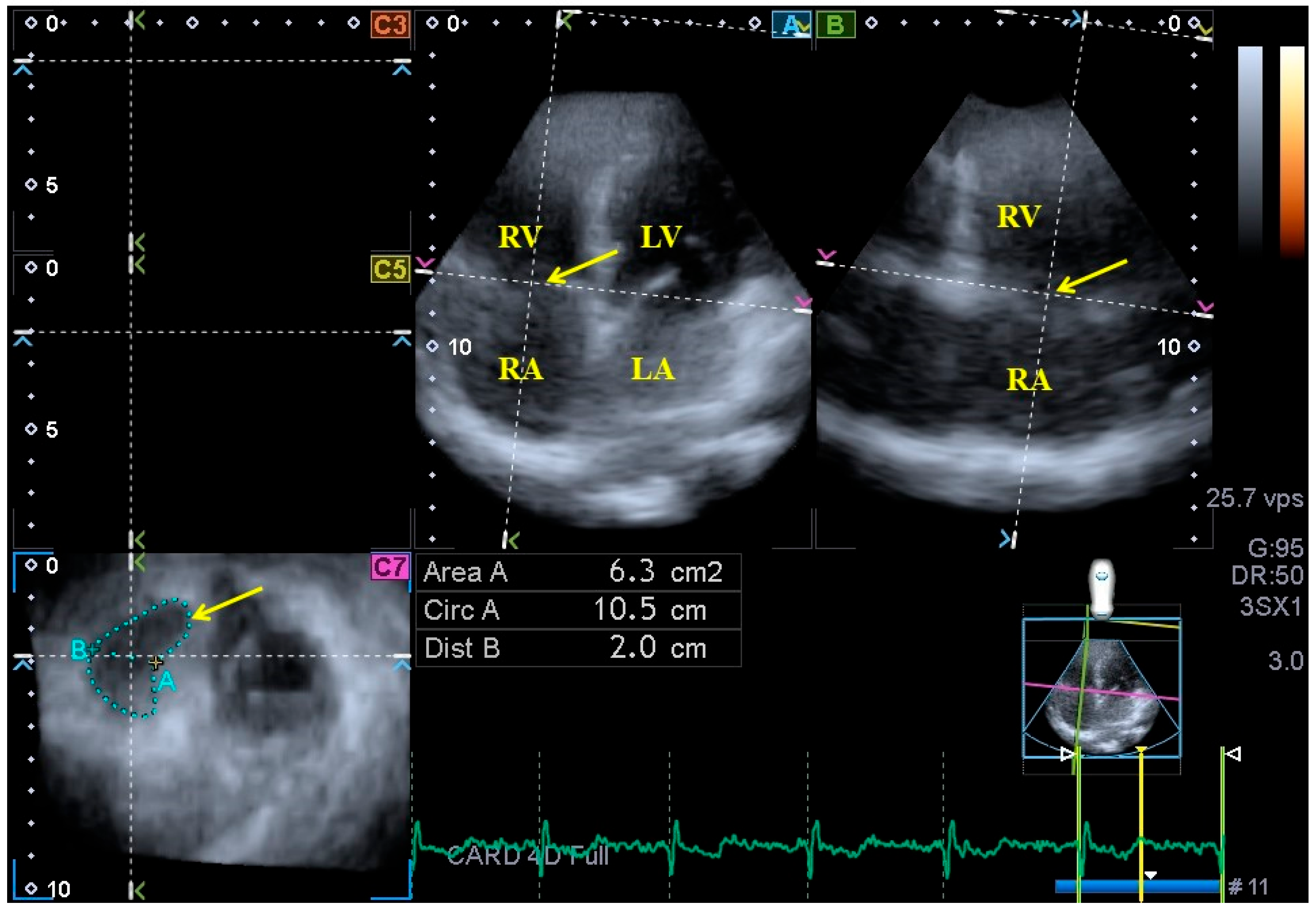 The Relationship between Tricuspid Annular Longitudinal and Sphincter ...