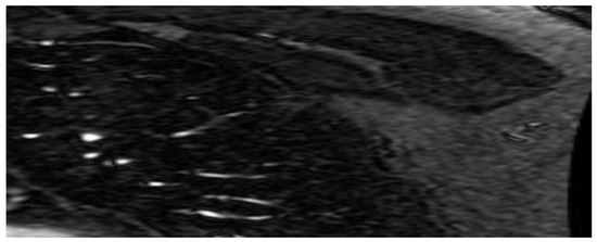 Improving Chest Monitoring through Magnetic Resonance Angiogram Image ...