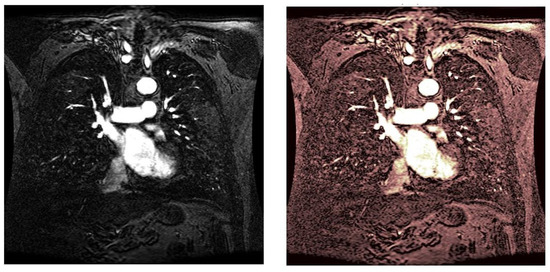 Improving Chest Monitoring through Magnetic Resonance Angiogram Image ...