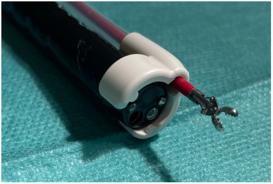 The Role of Specialized Instruments for Advanced Endoscopic Resections ...