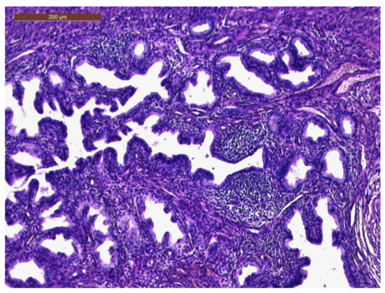 Prolapsed Atypical Polypoid Adenomyoma—A Case Report and Literature Review