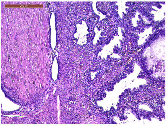 Prolapsed Atypical Polypoid Adenomyoma—A Case Report and Literature Review