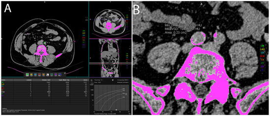 Life | Free Full-Text | Visceral and Ectopic Abdominal Fat Effect on ...