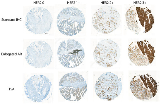 Loss of Human Epidermal Receptor 2 Expression in Formalin-Fixed ...