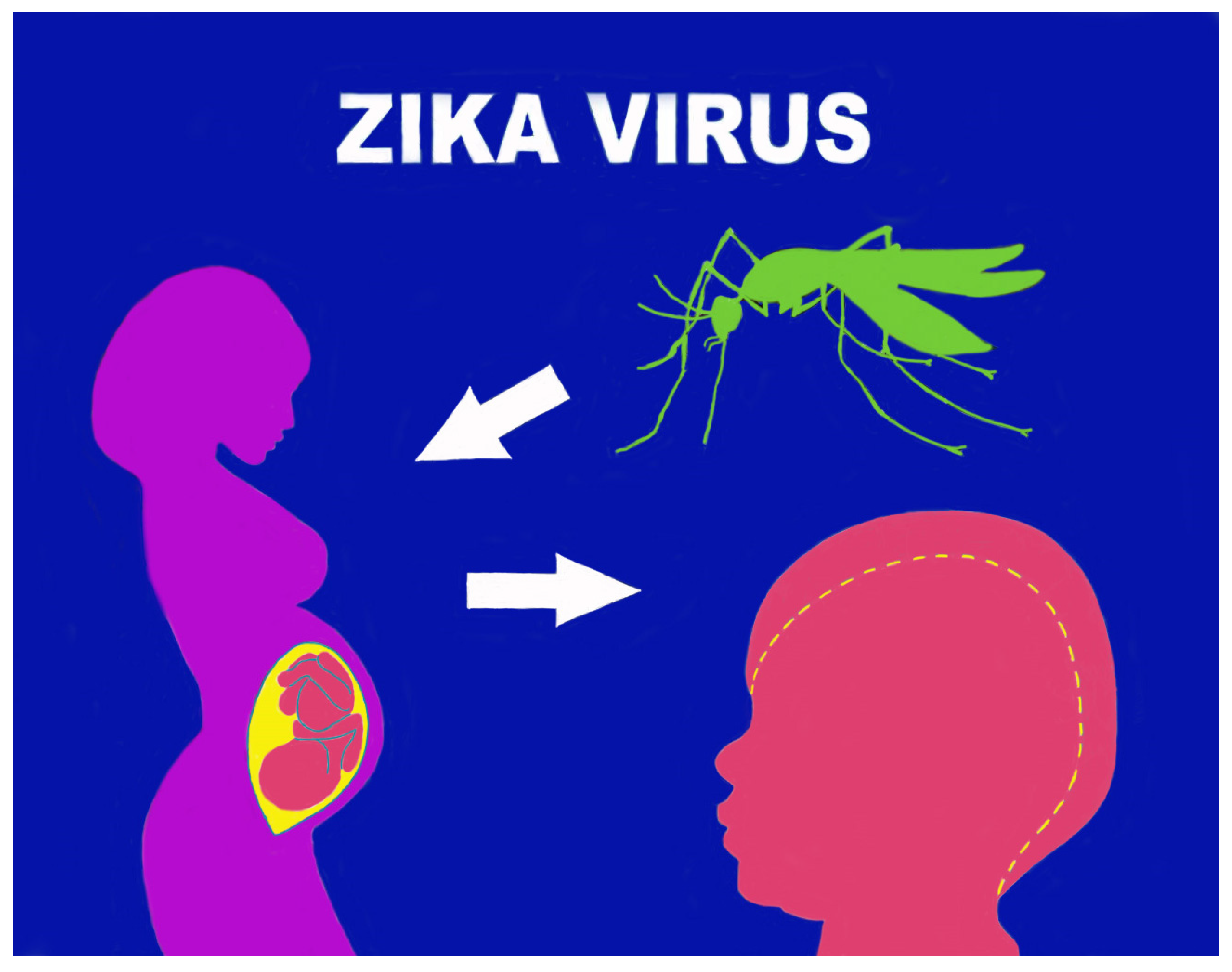 Life | Free Full-Text | Congenital Zika Virus Syndrome: Microcephaly and Orofacial Anomalies
