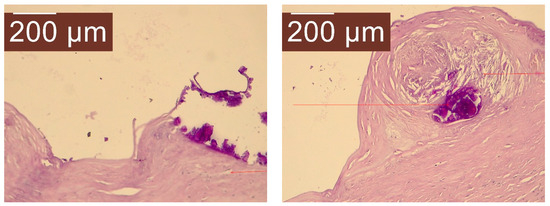 Laparoscopic Approach to Primary Splenic Cyst: Case Report and Review ...