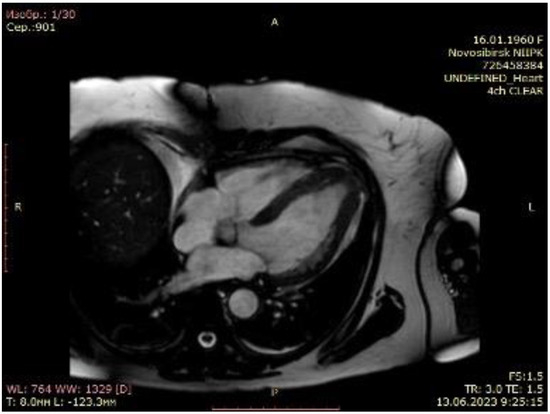 Transapical Approach to Septal Myectomy for Hypertrophic Cardiomyopathy