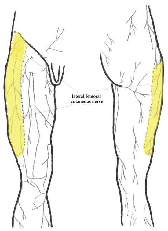 Life Free Full Text Meralgia Paresthetica—an Approach Specific