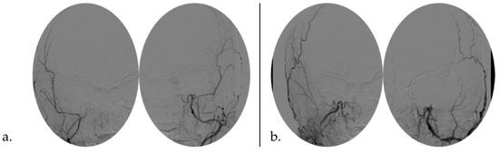 Spontaneous Intracranial Hypotension and Subdural Hematomas Treatment ...