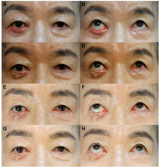 Lateral Tarsoplasty Combined with a Full-Thickness Skin Graft for ...