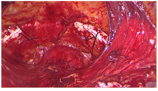 Evaluating Patient Preferences and Clinical Outcomes for Modified ...