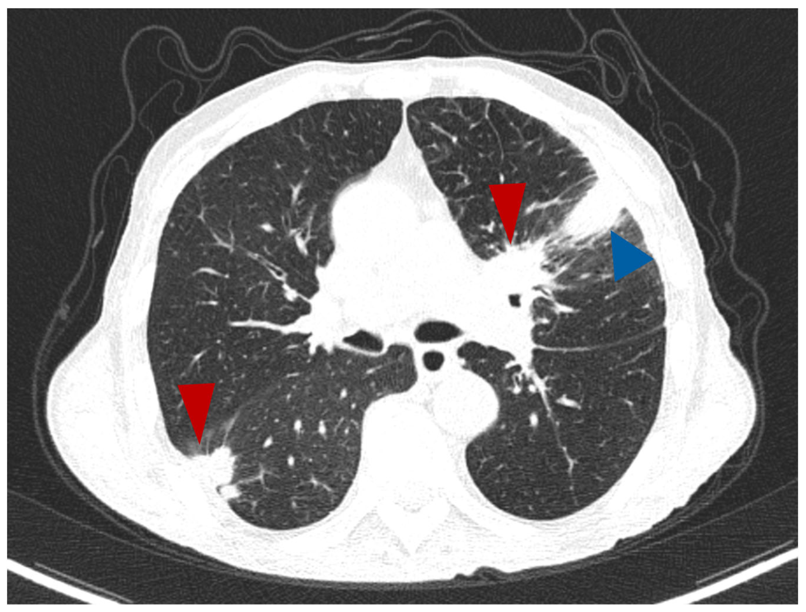 CT Imaging Patterns in Major Histological Types of Lung Cancer