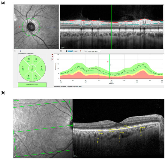 Looking into the Eyes to See the Heart of Chronic Kidney Disease Patients