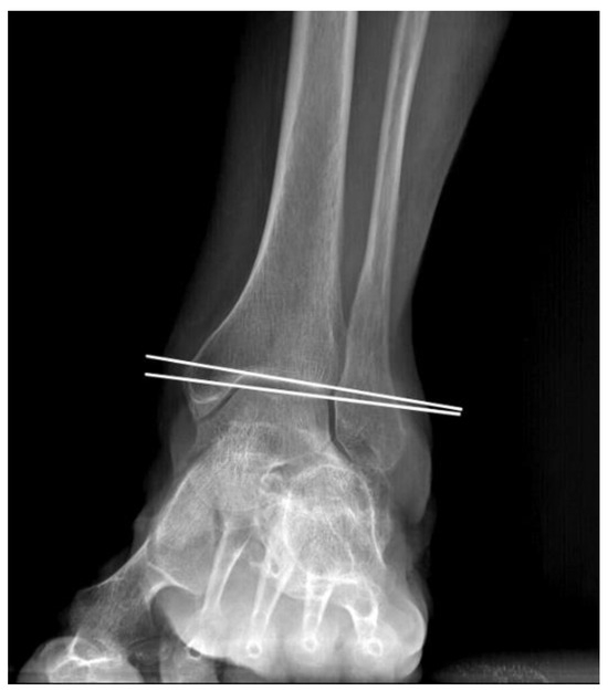 Impact of Subtalar Distraction Arthrodesis on Ankle Joint: Radiological ...