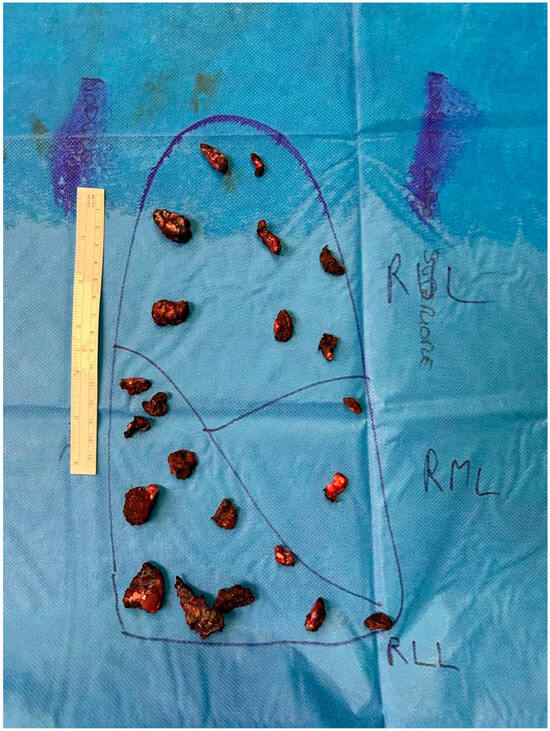 The Case for Pulmonary Metastasectomy—Clinical Practice Narrative ...