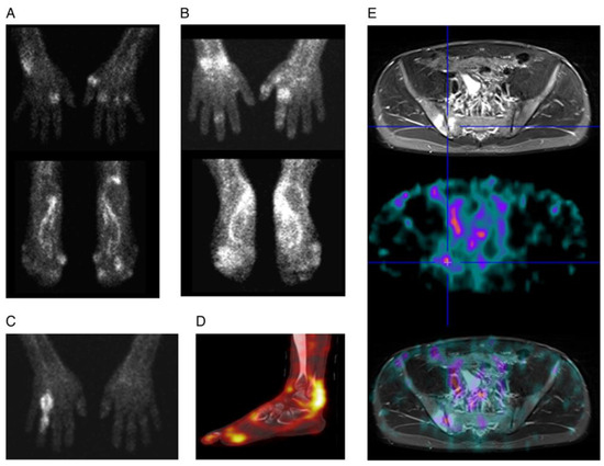 A Review of Advances in Molecular Imaging of Rheumatoid Arthritis: From ...