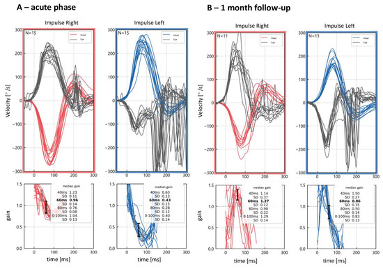 Life | Free Full-Text | Application of a Video Head Impulse Test in the ...