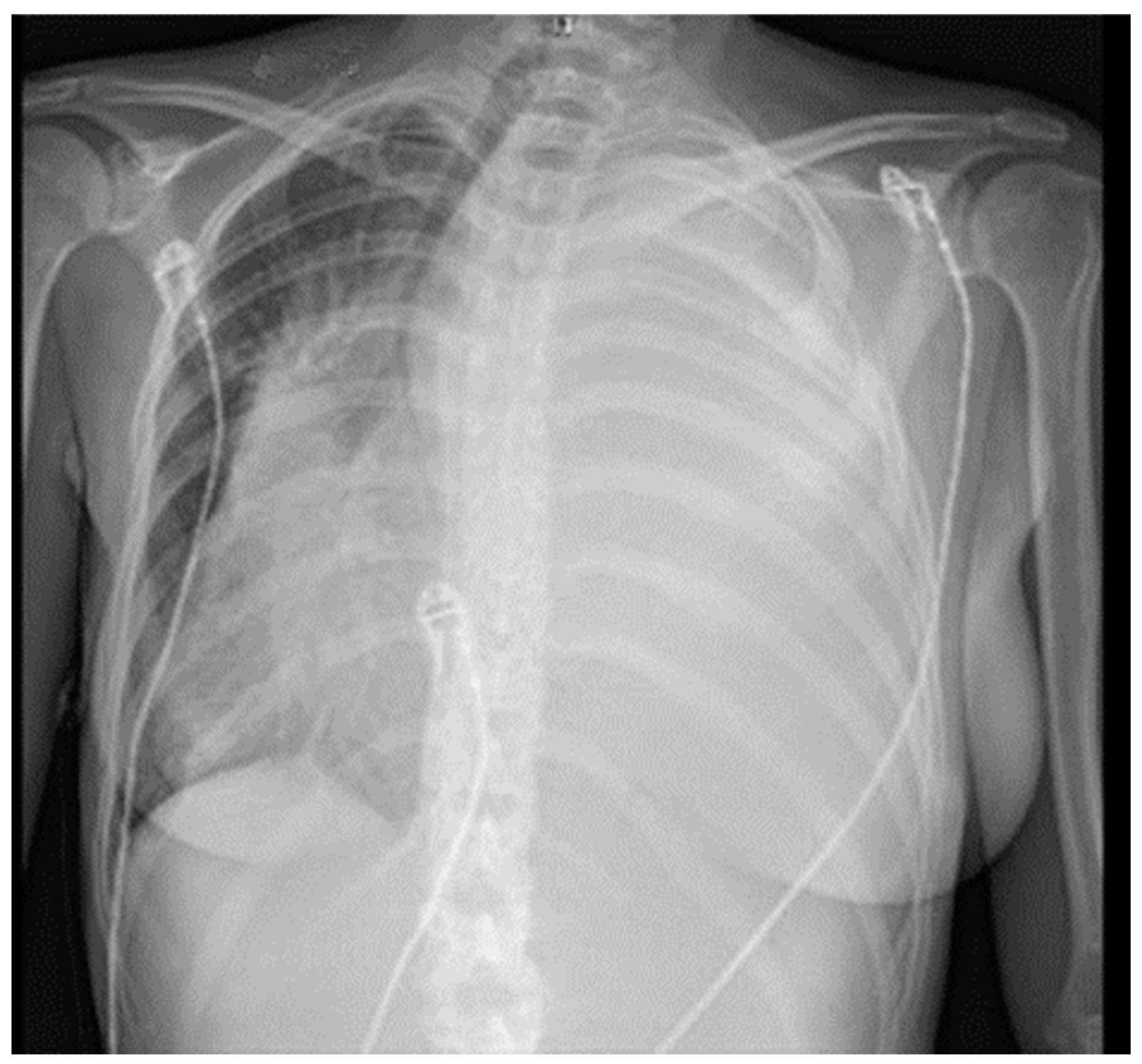 Primary Chest Wall Ewing Sarcoma: Treatment and Long-Term Results