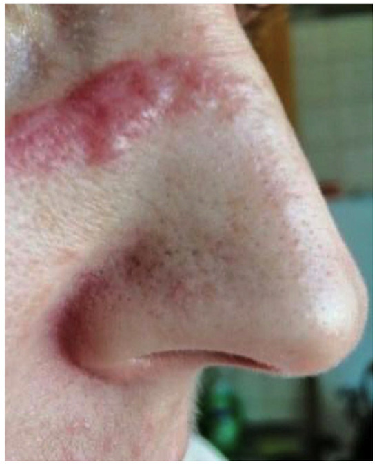 Lupus Pernio Sarcoidosis