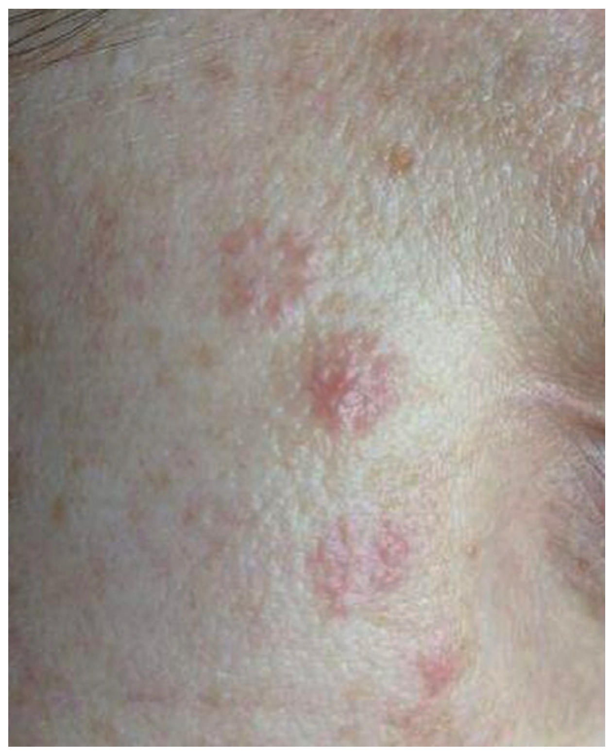 Life | Free Full-Text | Cutaneous Sarcoidosis Induced by Laser Therapy ...