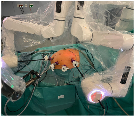 The Combination of Laparoscopic and Robotic Surgery: First Experience ...