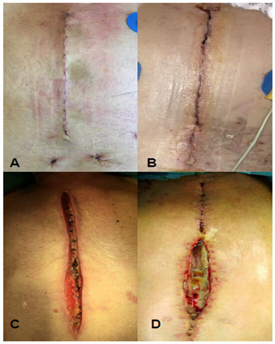 Randomized Controlled Trial: Does the Use of Occlusive Hydrocolloid ...