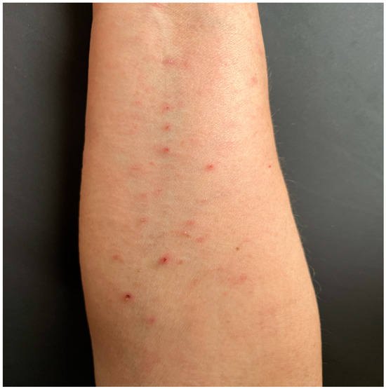 Disseminate Cutaneous Vasculitis Associated with Durvalumab Treatment ...