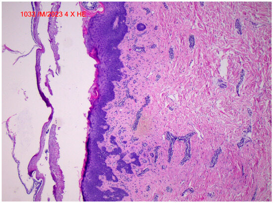 Disseminate Cutaneous Vasculitis Associated with Durvalumab Treatment ...