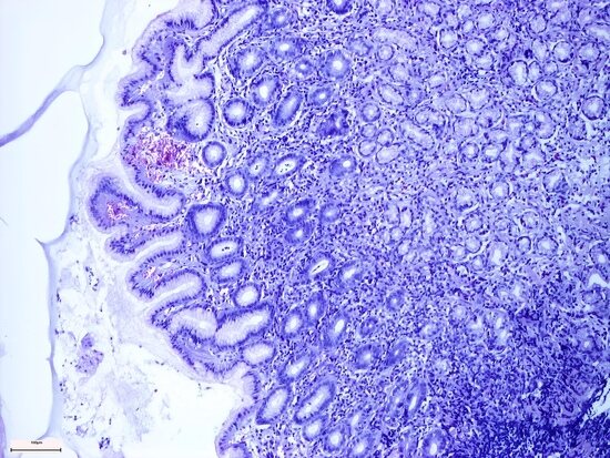 Type 2 Diabetes Mellitus and Helicobacter pylori Gastritis in Patients ...