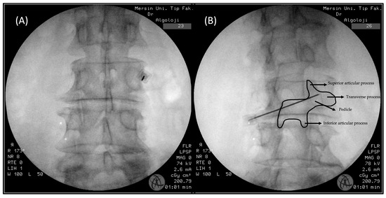 Comparison of Radiation Doses for Different Techniques in Fluoroscopy ...