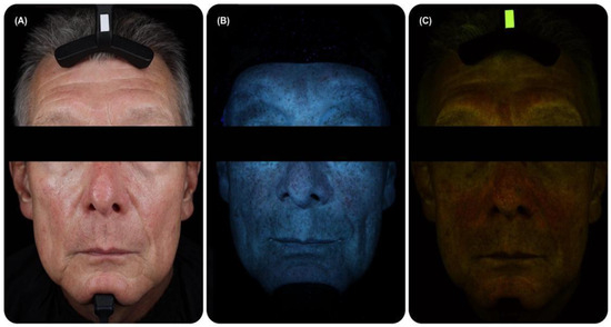 State-of-the-Art in Skin Fluorescent Photography for Cosmetic and ...