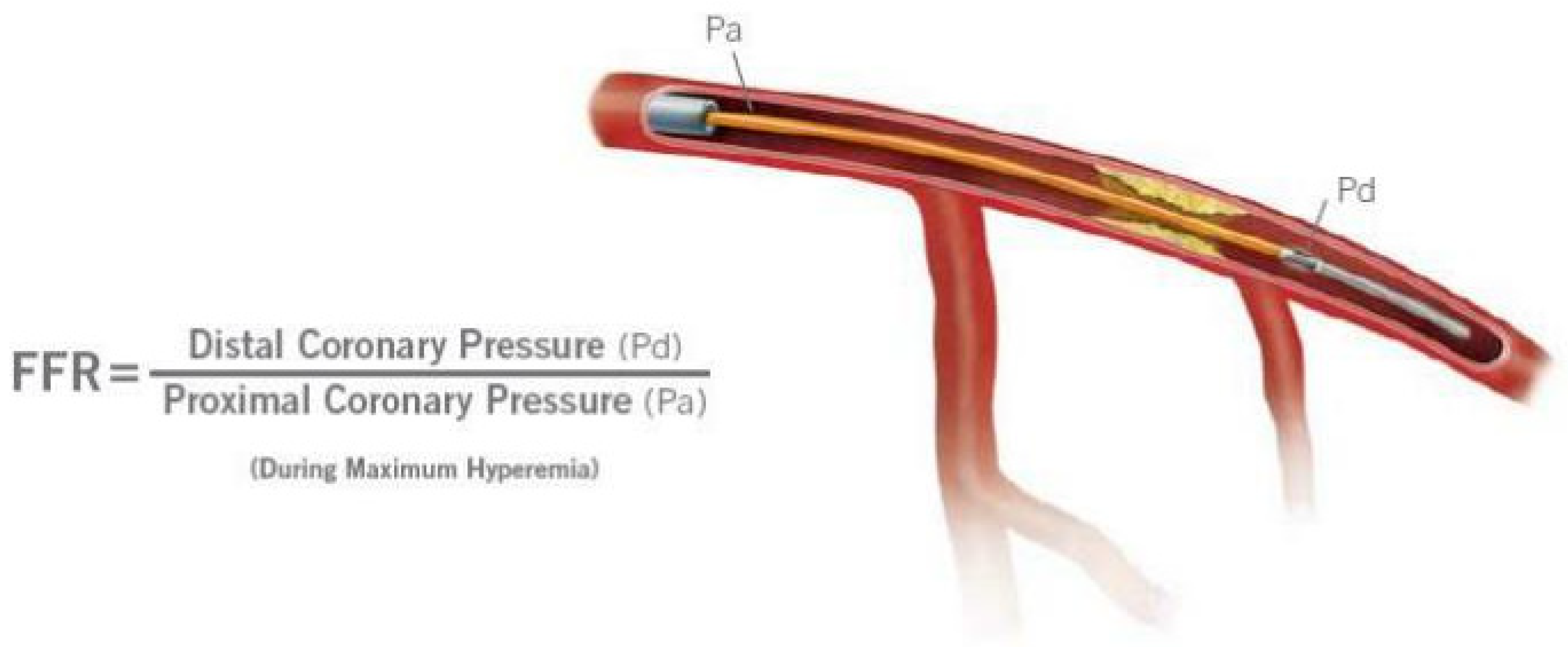 Fractional Flow Reserve Implications for Clinical Decision Making in Coronary Artery Disease