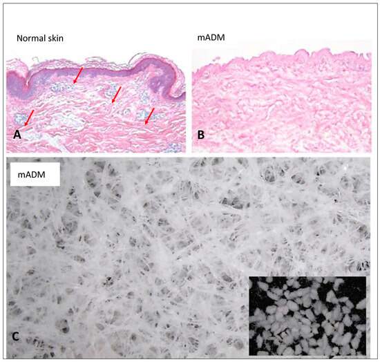 Advanced Secondary Intention Healing for Complex Soft-Tissue Defects ...