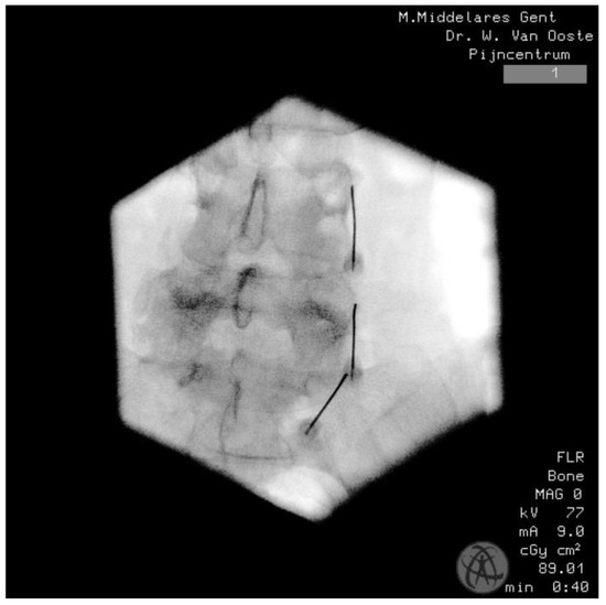 Lumbar Facet Joint Disease: What, Why, and When?