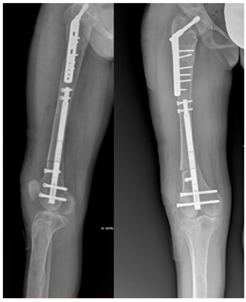 Reactivating Sleeping Intramedullary Nail in a 16-Year-Old Female with ...