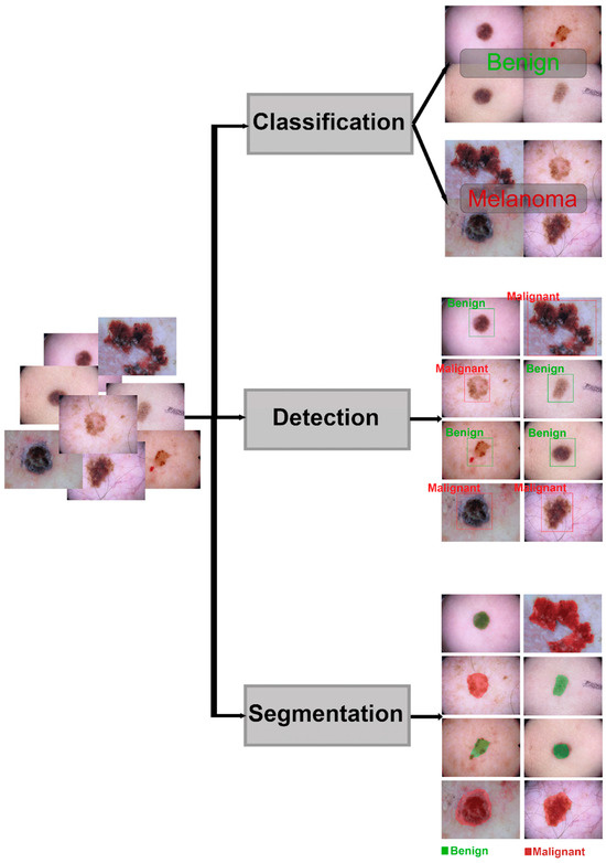 Artificial Intelligence in the Non-Invasive Detection of Melanoma
