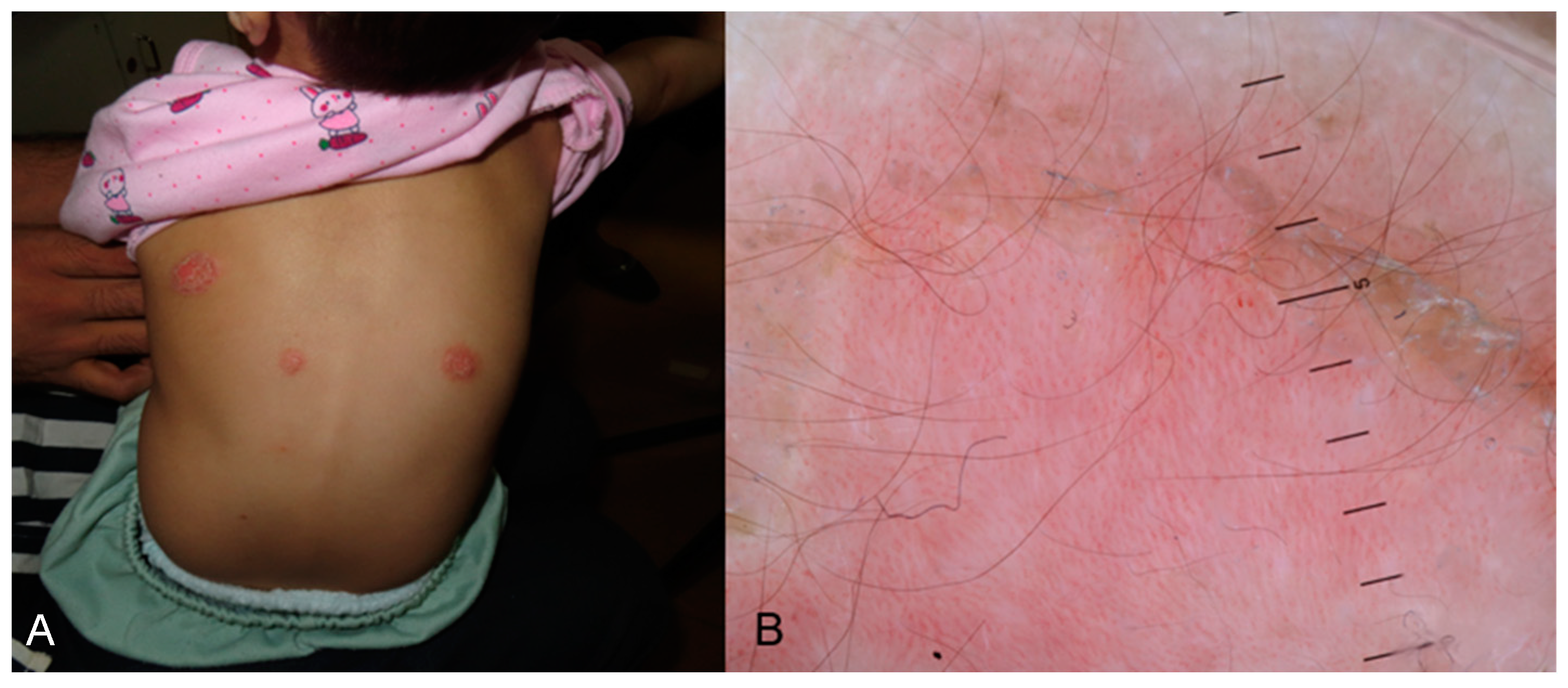 Exploring Pediatric Dermatology in Skin of Color: Focus on Dermoscopy
