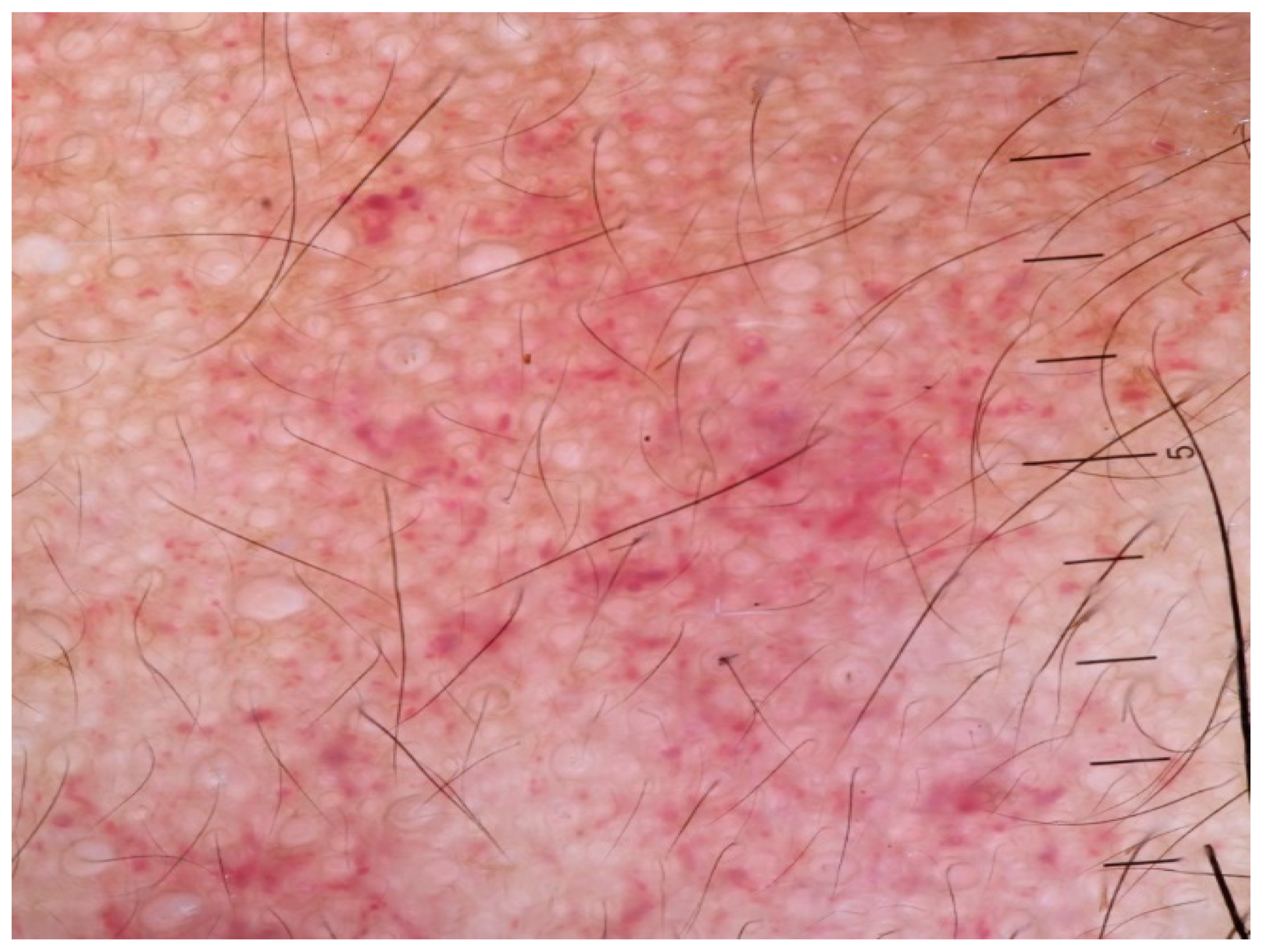 Exploring Pediatric Dermatology in Skin of Color: Focus on Dermoscopy