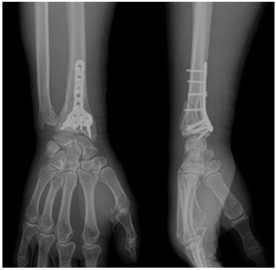 Comparative Biomechanical Analysis of Kirschner Wire Fixation in ...