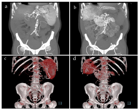 Spleno-Mesenteric Venous Blood Flow Dynamics in Adult Patients with ...