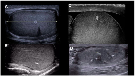 An Insight into Testicular Macrocalcification—A Retrospective Study of ...